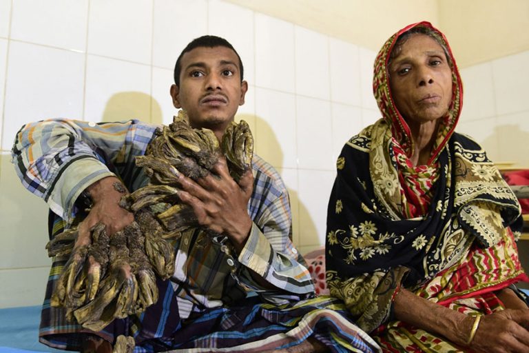 Bangladeshi ‘tree man’ finally got his warts removed