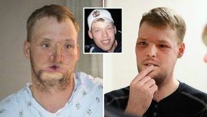 Suicide victim gets his face reconstructed in transplant surgery