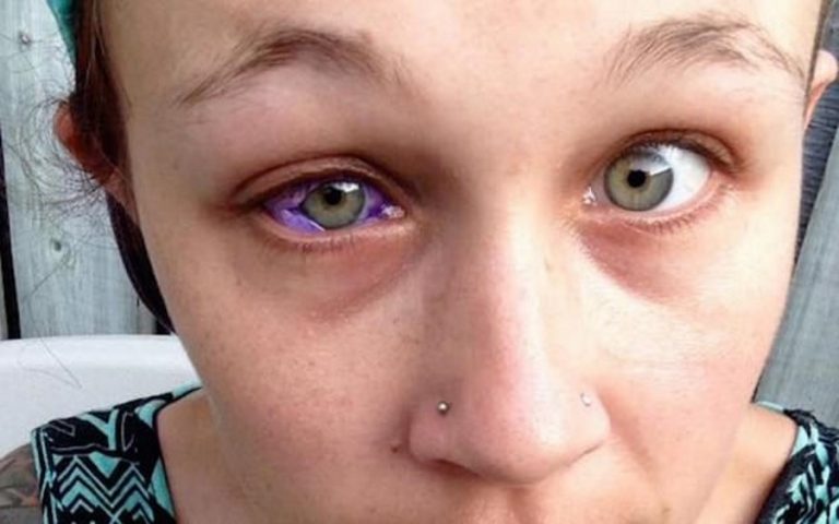 Model shedding purple tears at risk of losing eye after scleral tattoo ...